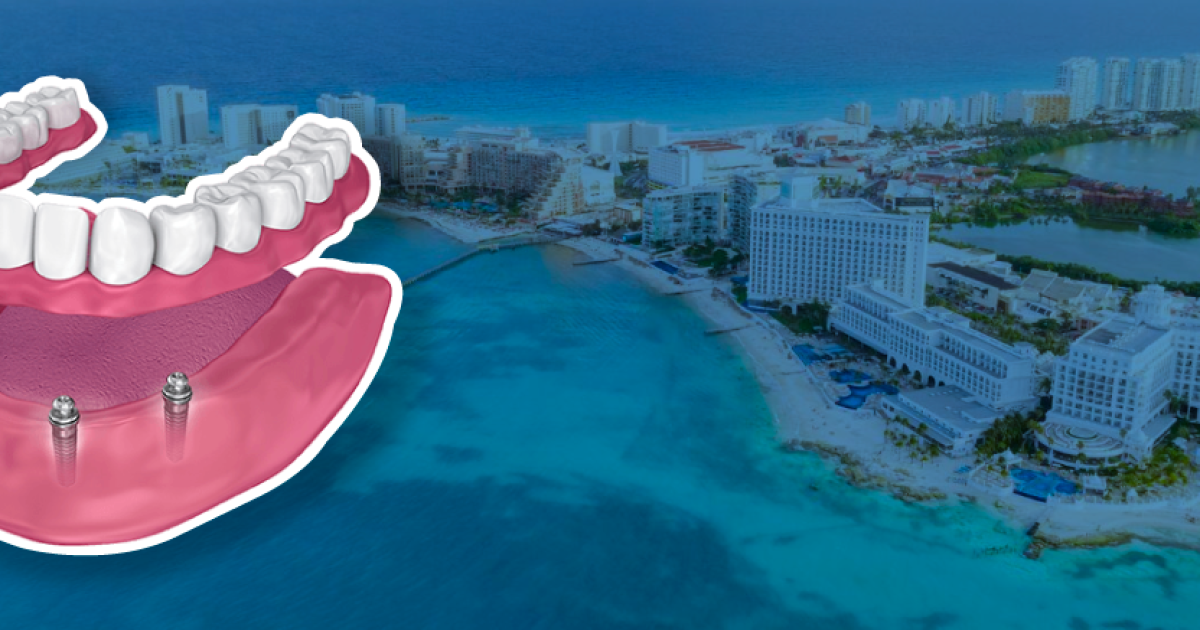 All-on-4 Dental Implants in Cancun: Transform Your Smile Today!